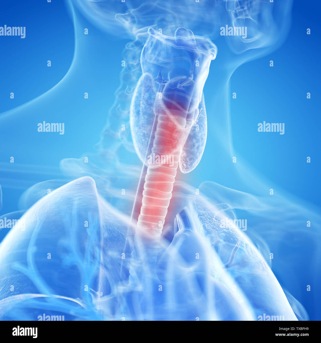 3d rendered, medically accurate illustration of an inflamed trachea ...