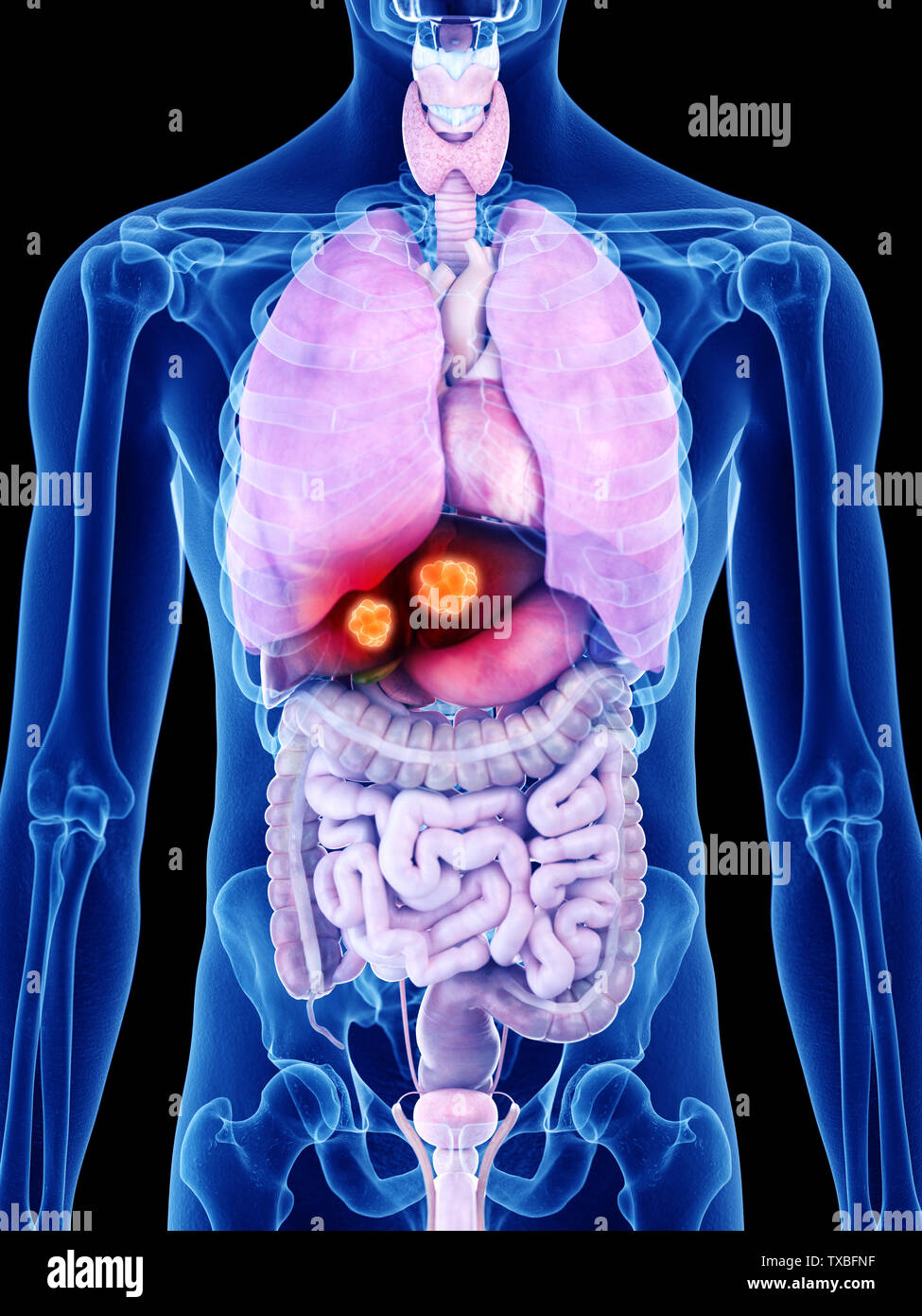 3d rendered medically accurate illustration of liver cancer Stock Photo ...