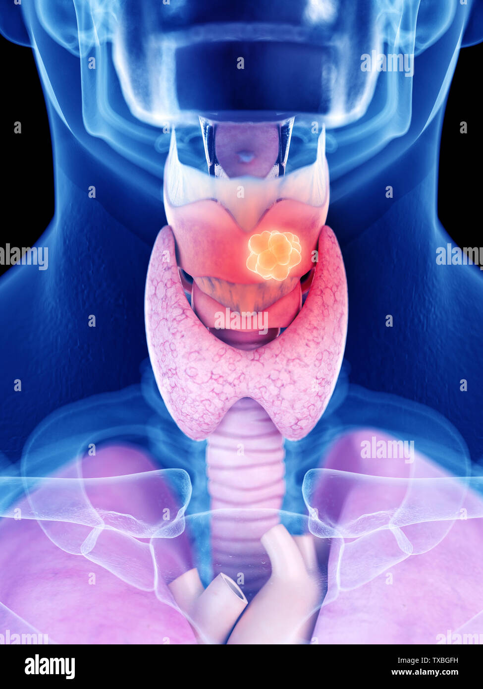 Larynx cancer hi-res stock photography and images - Alamy