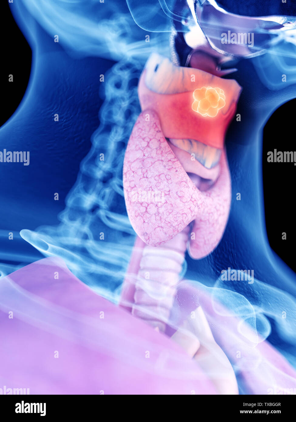 3d rendered medically accurate illustration of larynx cancer Stock ...