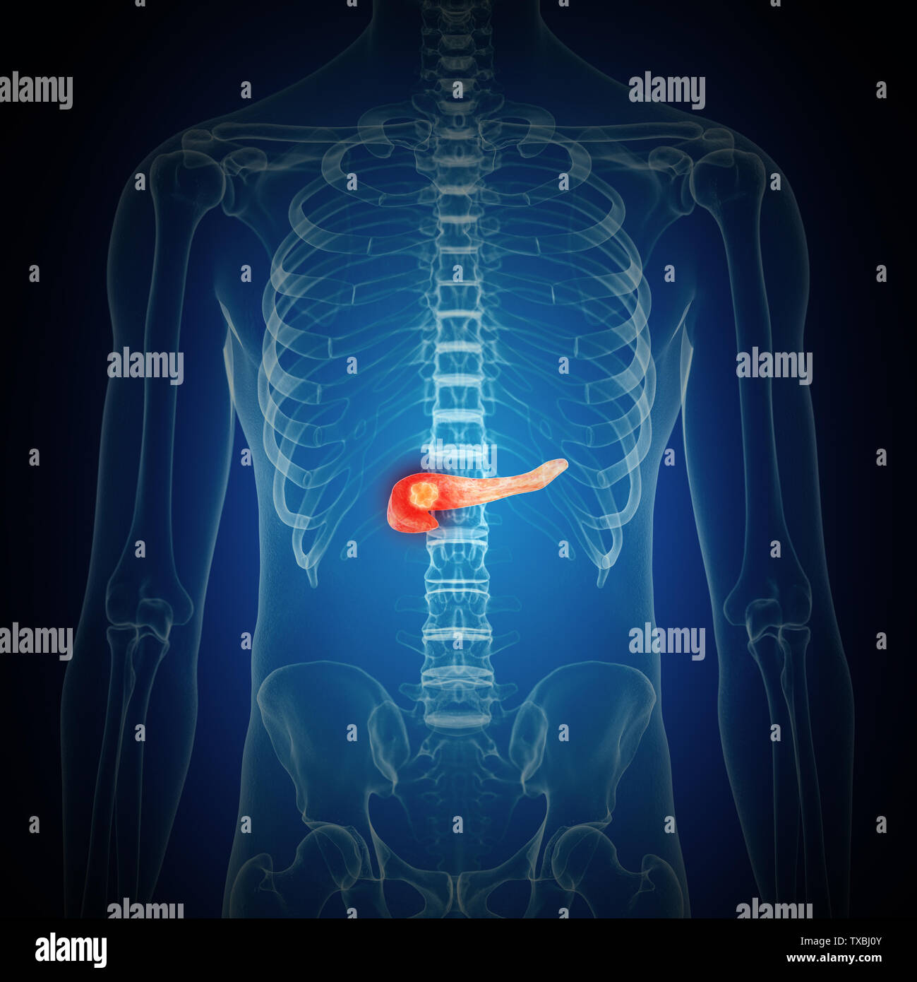 Pancreas Cancer High Resolution Stock Photography and Images - Alamy
