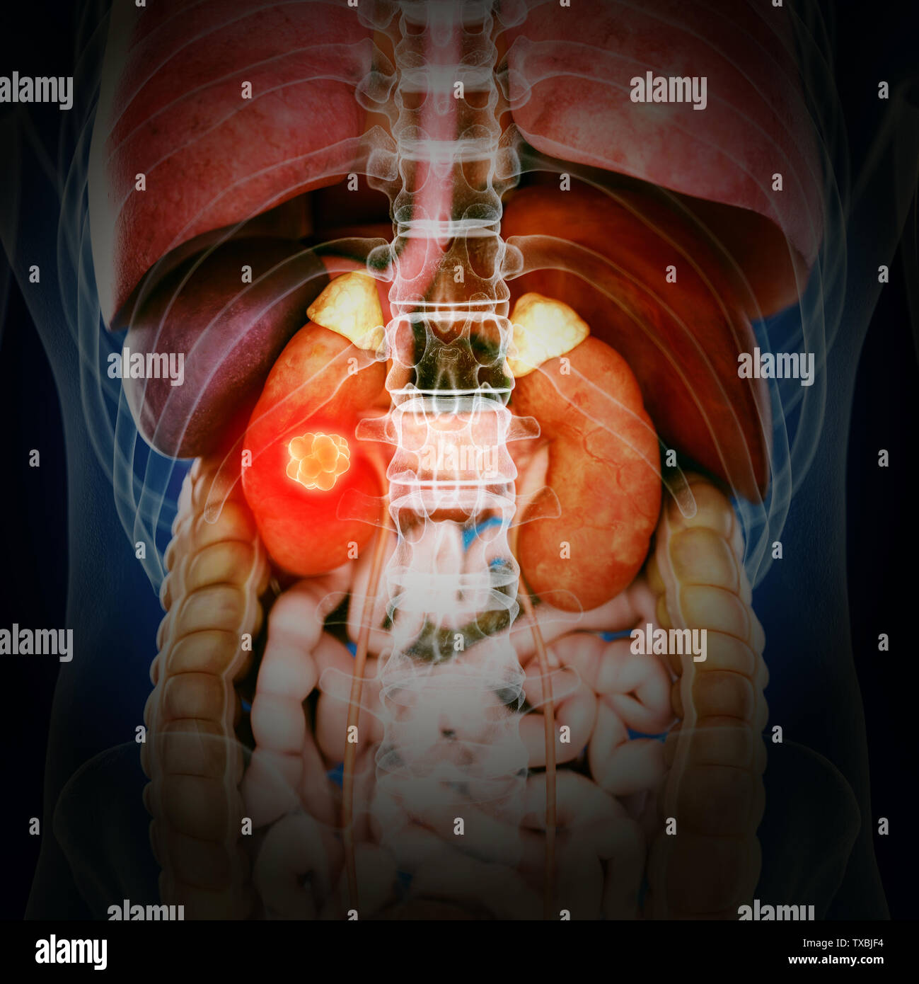 Kidney cancer hi-res stock photography and images - Alamy