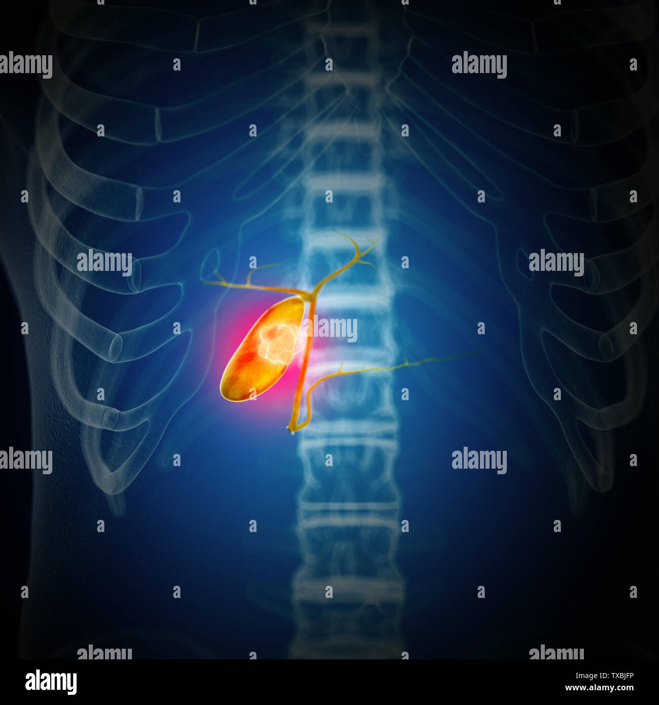 3d rendered medically accurate illustration of gallbladder cancer Stock ...