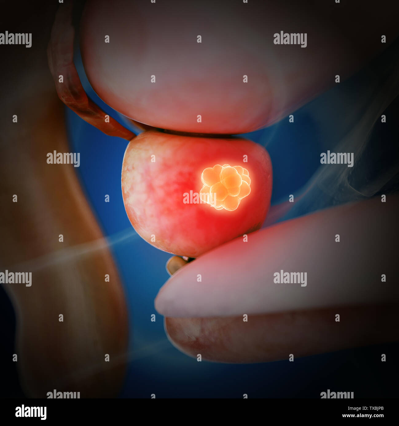 Prostate cancer hi-res stock photography and images - Alamy