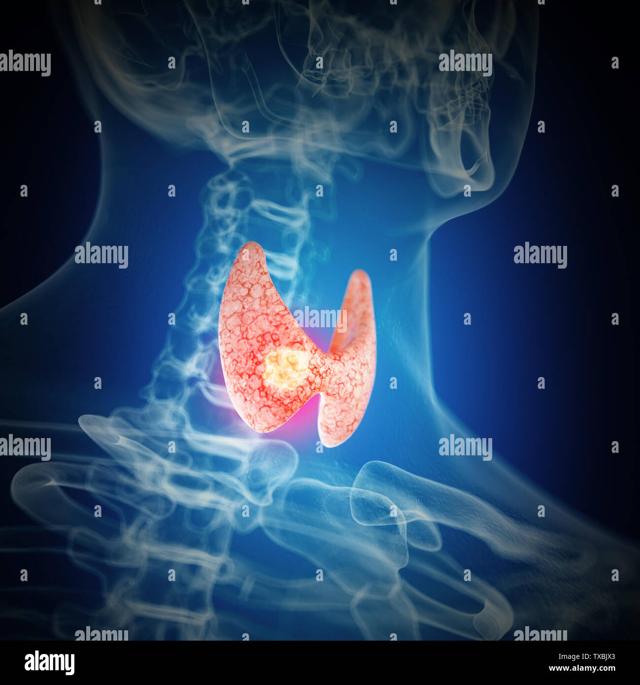 3d rendered medically accurate illustration of thyroid cancer Stock ...