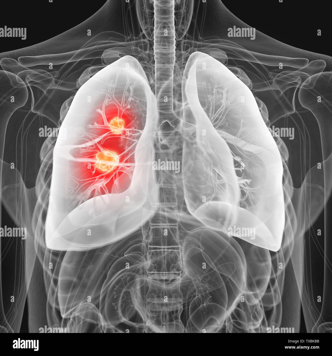 3d rendered medically accurate illustration of lung cancer Stock Photo ...