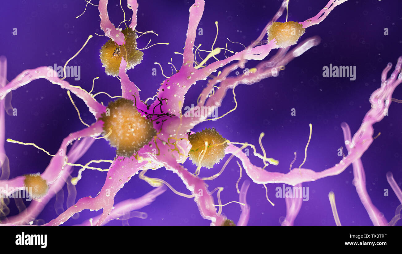 Amyloid plaques plaque hi-res stock photography and images - Alamy