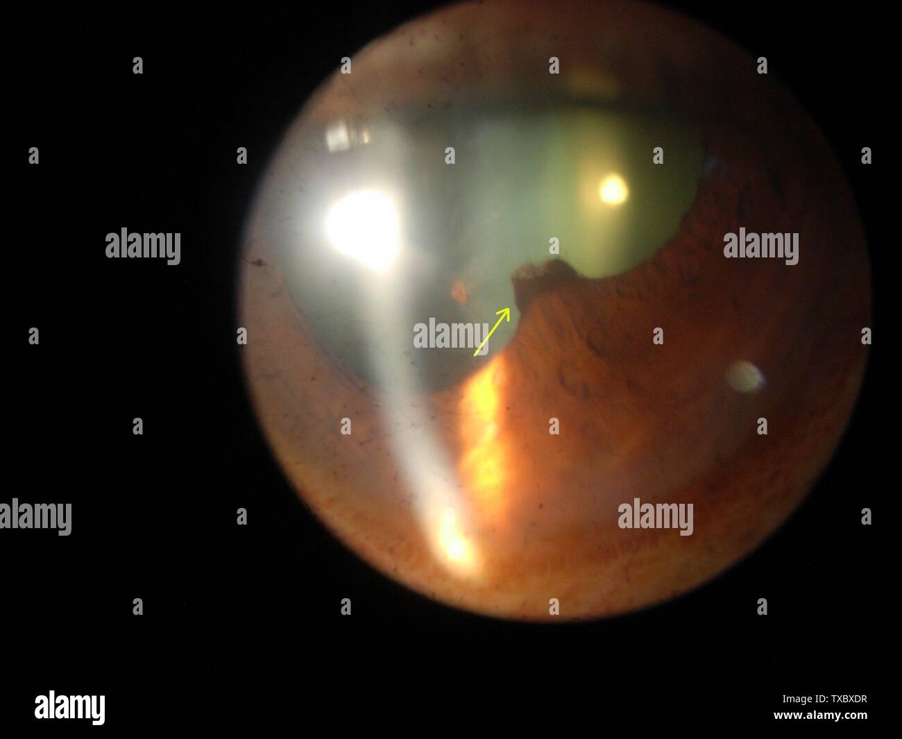 Synechia hi-res stock photography and images - Alamy