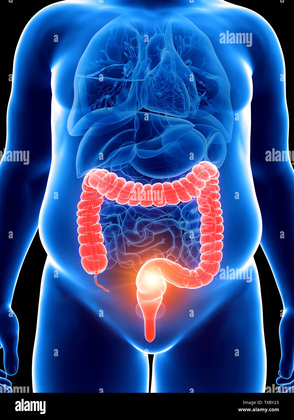 3d rendered medically accurate illustration of a obese man with a ...