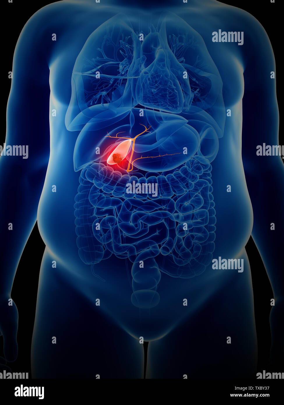 3d rendered, medically accurate illustration of gallbladder cancer ...