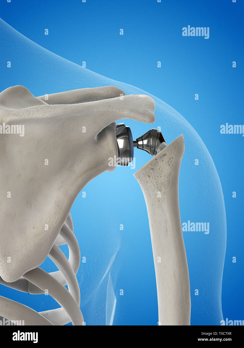 3d rendered medically accurate illustration of a shoulder replacement ...