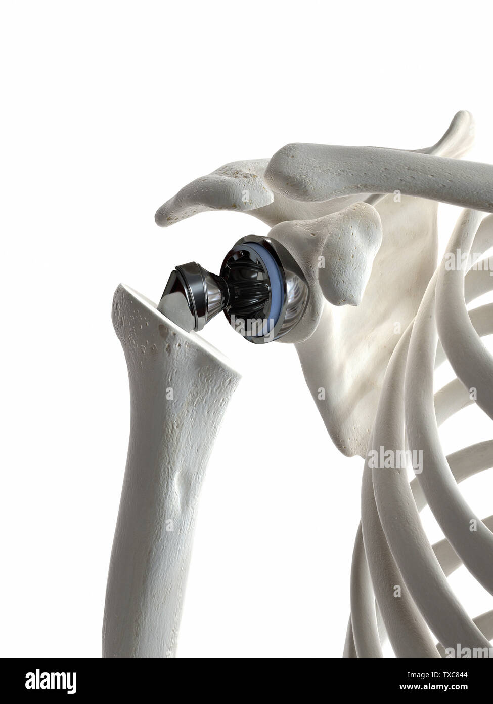 3d rendered medically accurate illustration of a shoulder replacement ...