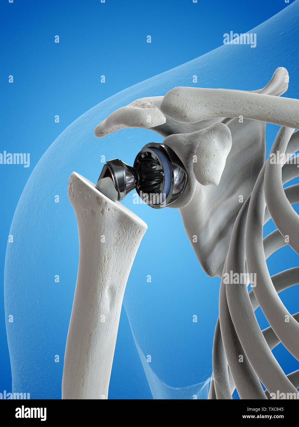 Shoulder Joint Replacement High Resolution Stock Photography and Images ...