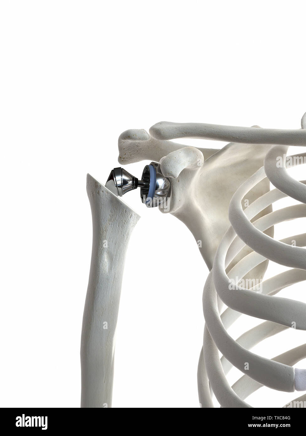 3d rendered medically accurate illustration of a shoulder replacement ...