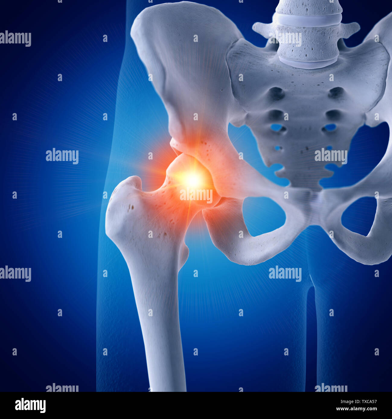 3d rendered medically accurate illustration of a painful hip joint ...