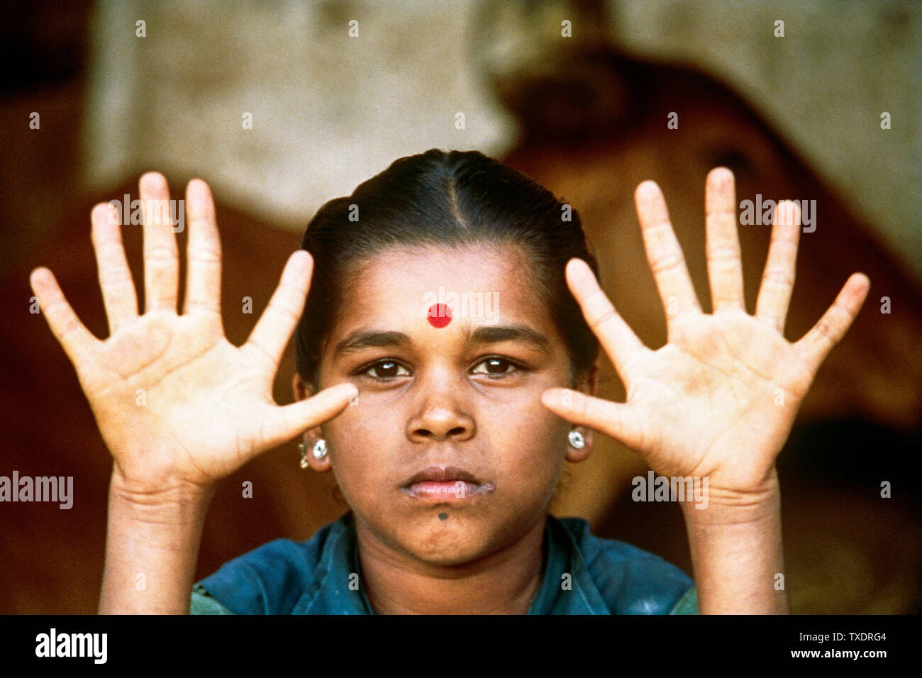 Young girl with six fingers on both hands, Gujarat, India, Asia Stock ...