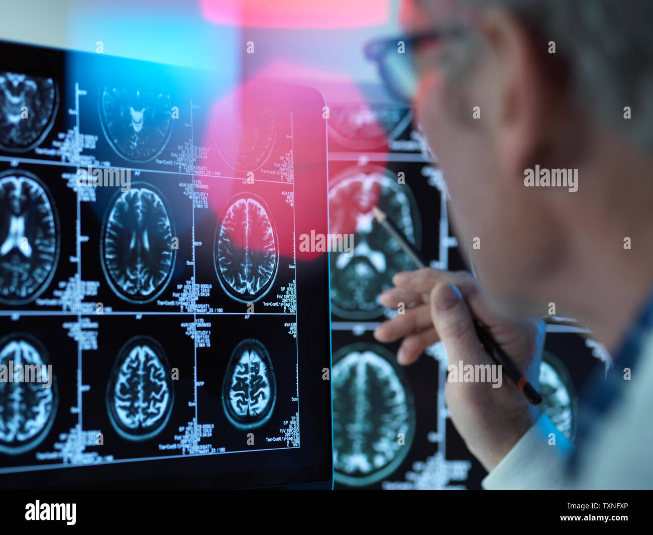 Alzheimers brain scans hi-res stock photography and images - Alamy