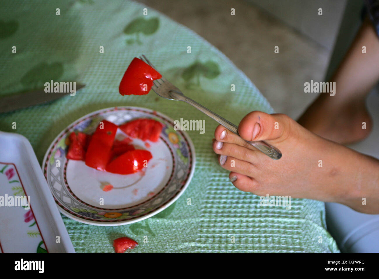 A Palestinian girl, nine-year-old Aya Wael Masoud, who was born without ...