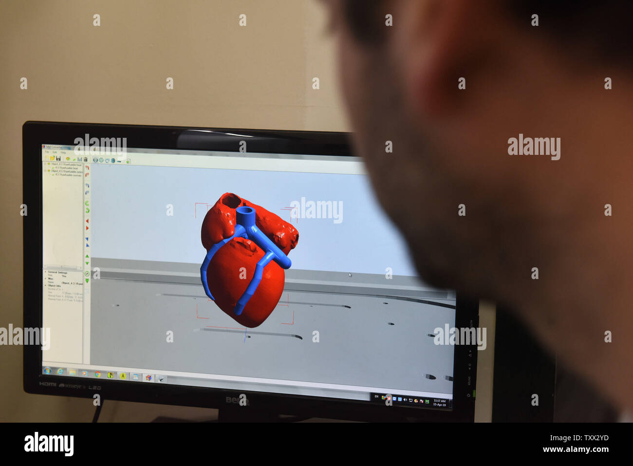 Dr. Assaf Shapira looks at a digital image of a 3D printed heart, which ...