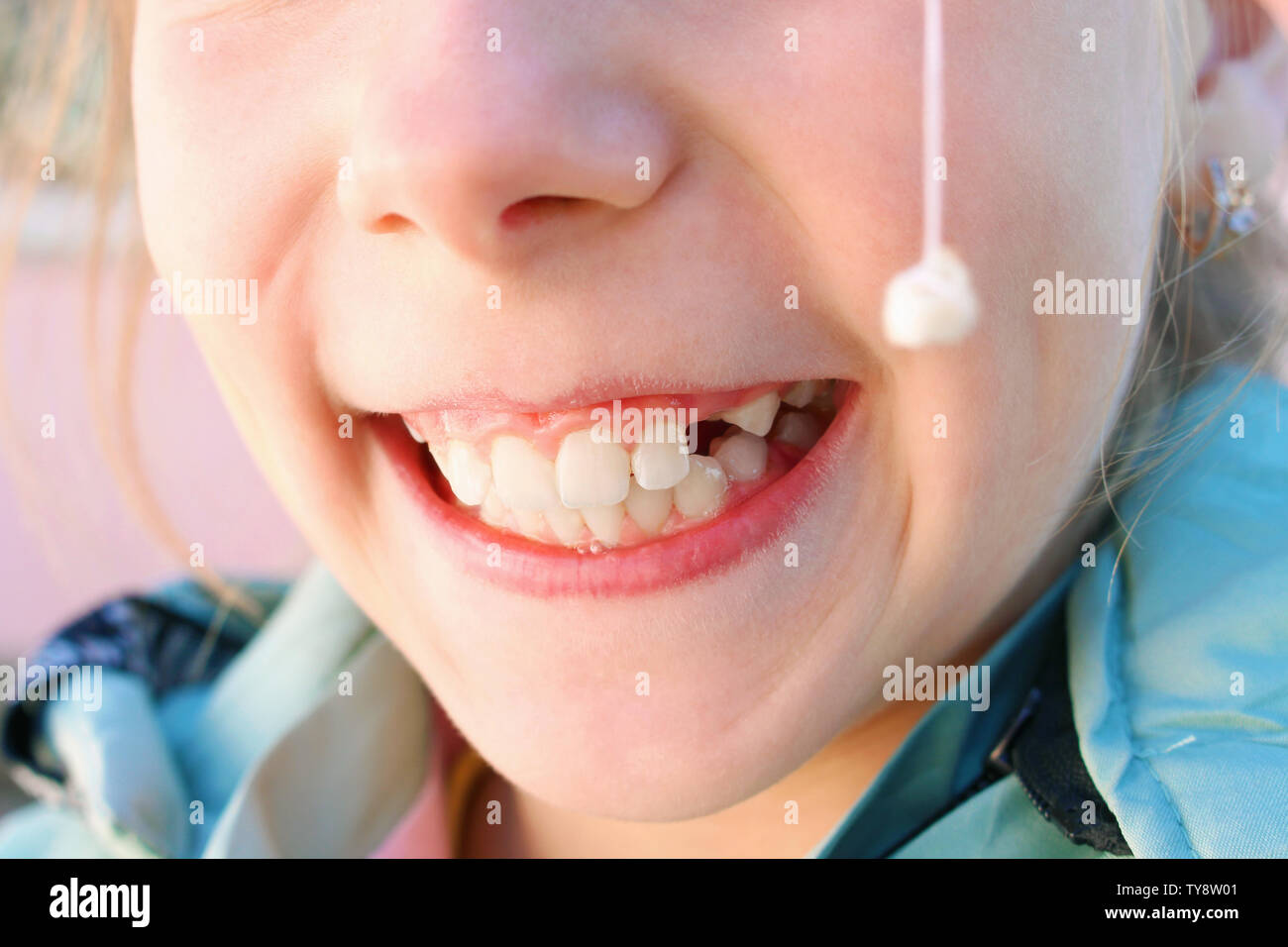 Tooth pulled hi-res stock photography and images - Alamy