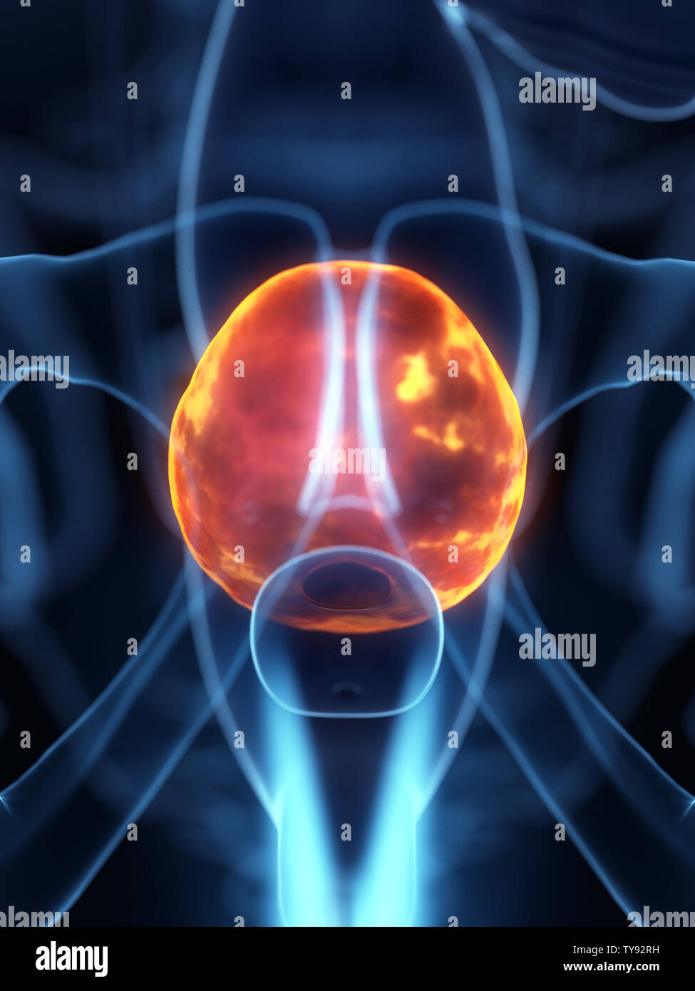3d rendered medically accurate illustration of a diseased bladder Stock ...