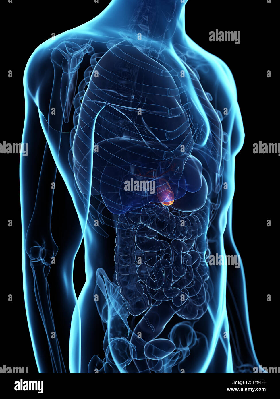 3d rendered medically accurate illustration of a diseased gallbladder ...