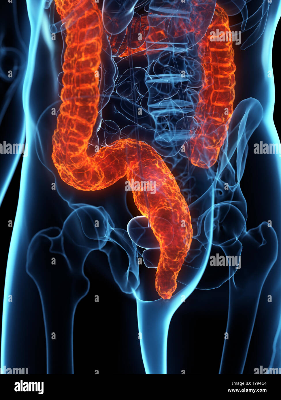3d rendered medically accurate illustration of a diseased colon Stock ...