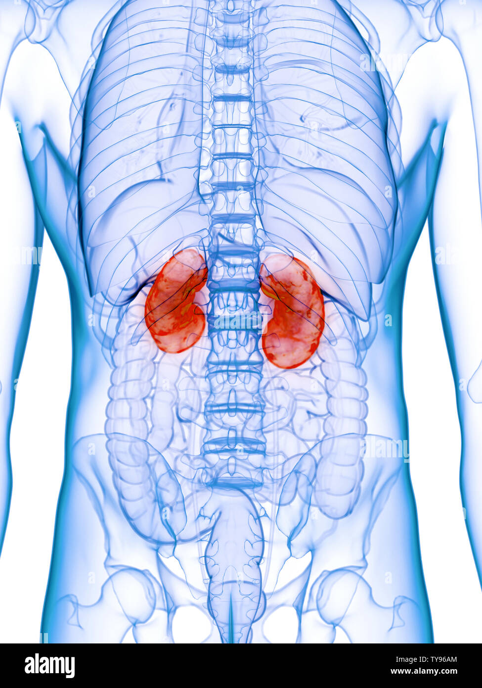 3d rendered medically accurate illustration of a diseased kidney Stock ...