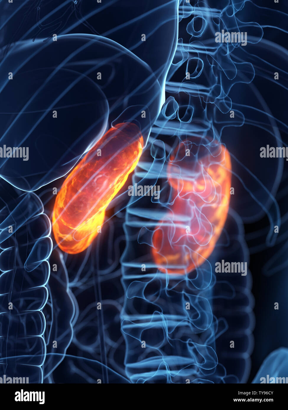 3d rendered medically accurate illustration of a diseased kidney Stock ...
