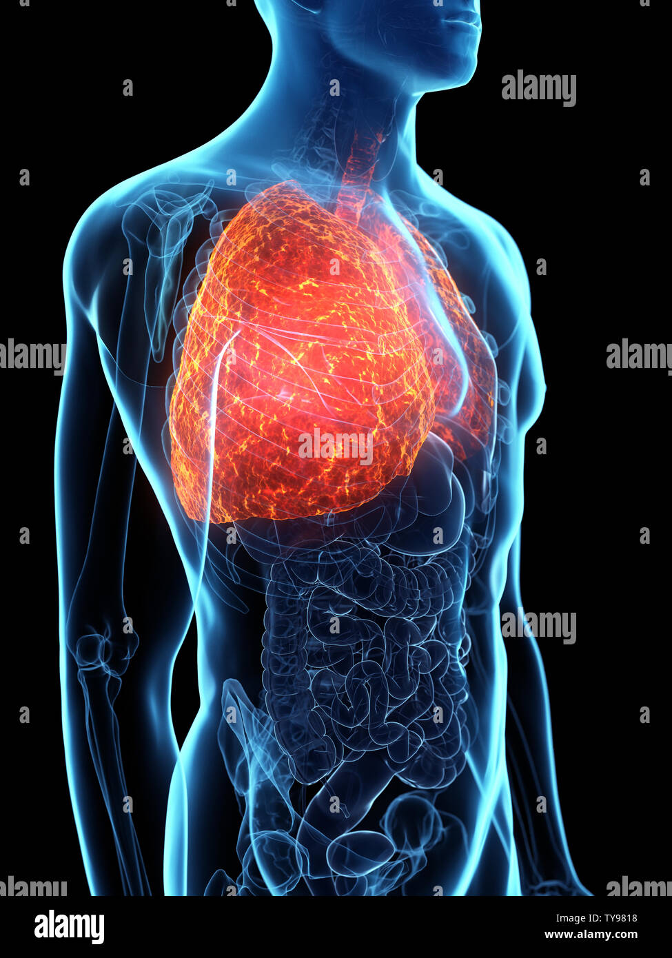3d rendered medically accurate illustration of a diseased lung Stock ...