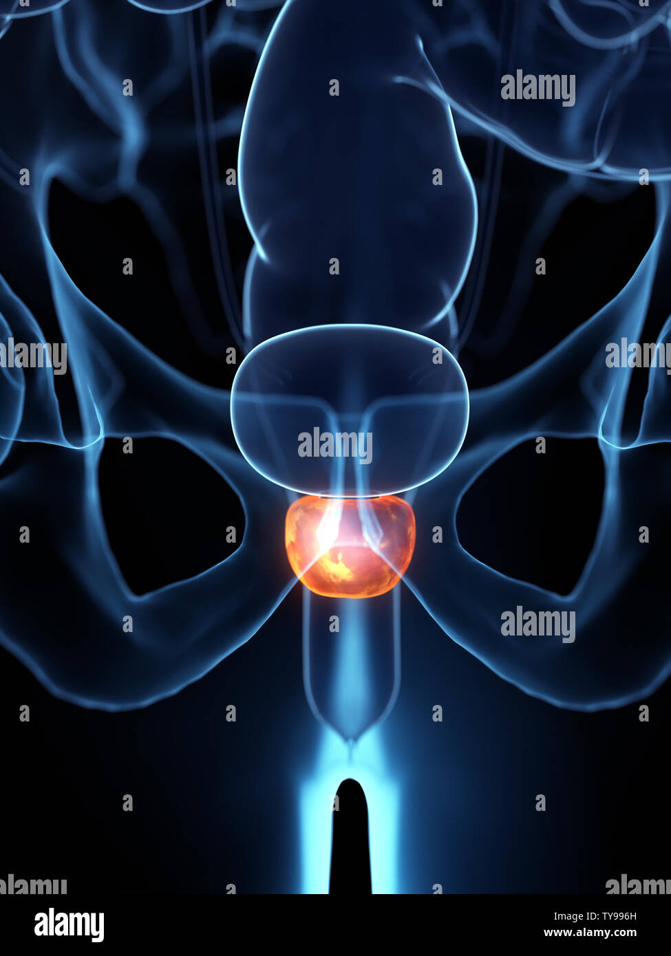 3d rendered medically accurate illustration of an inflamed prostate ...