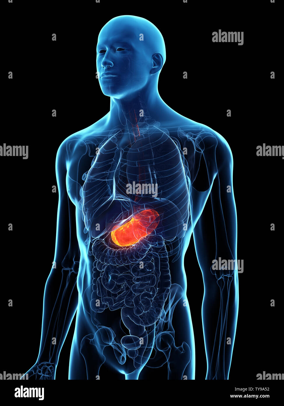 3d rendered medically accurate illustration of a diseased stomach Stock ...