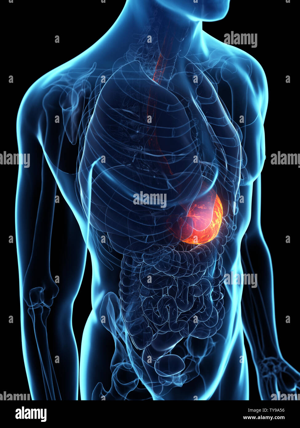 3d rendered medically accurate illustration of a diseased stomach Stock ...