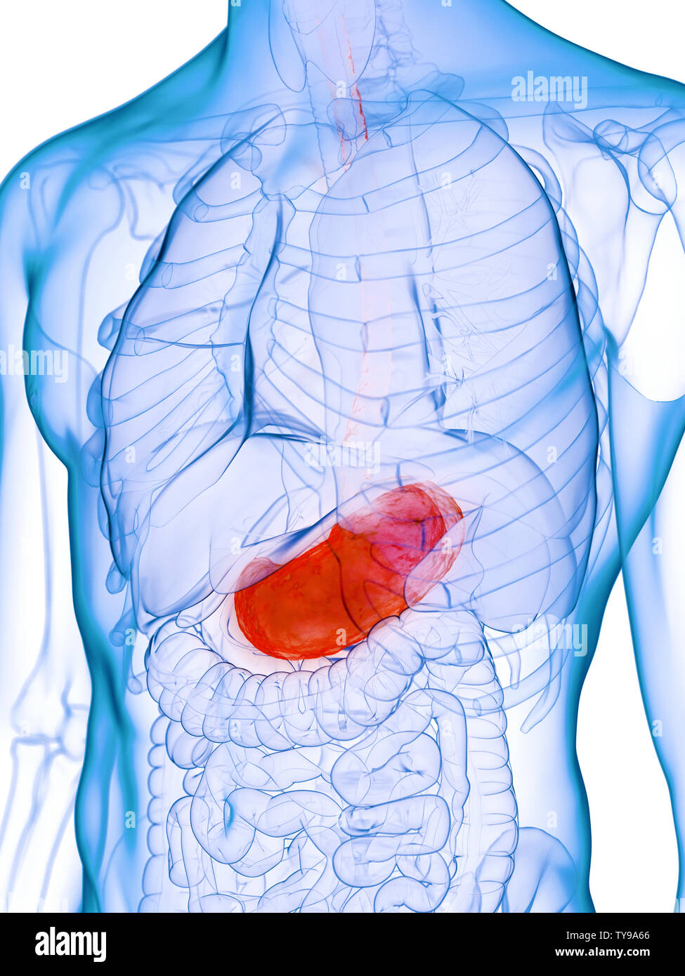 3d rendered medically accurate illustration of a diseased stomach Stock ...
