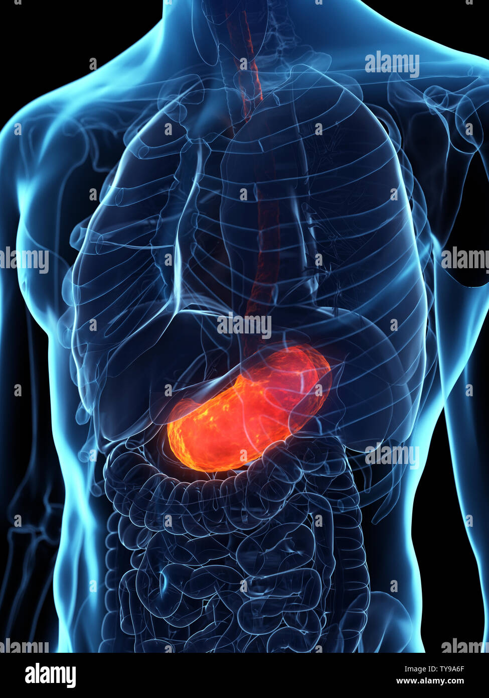 3d rendered medically accurate illustration of a diseased stomach Stock ...