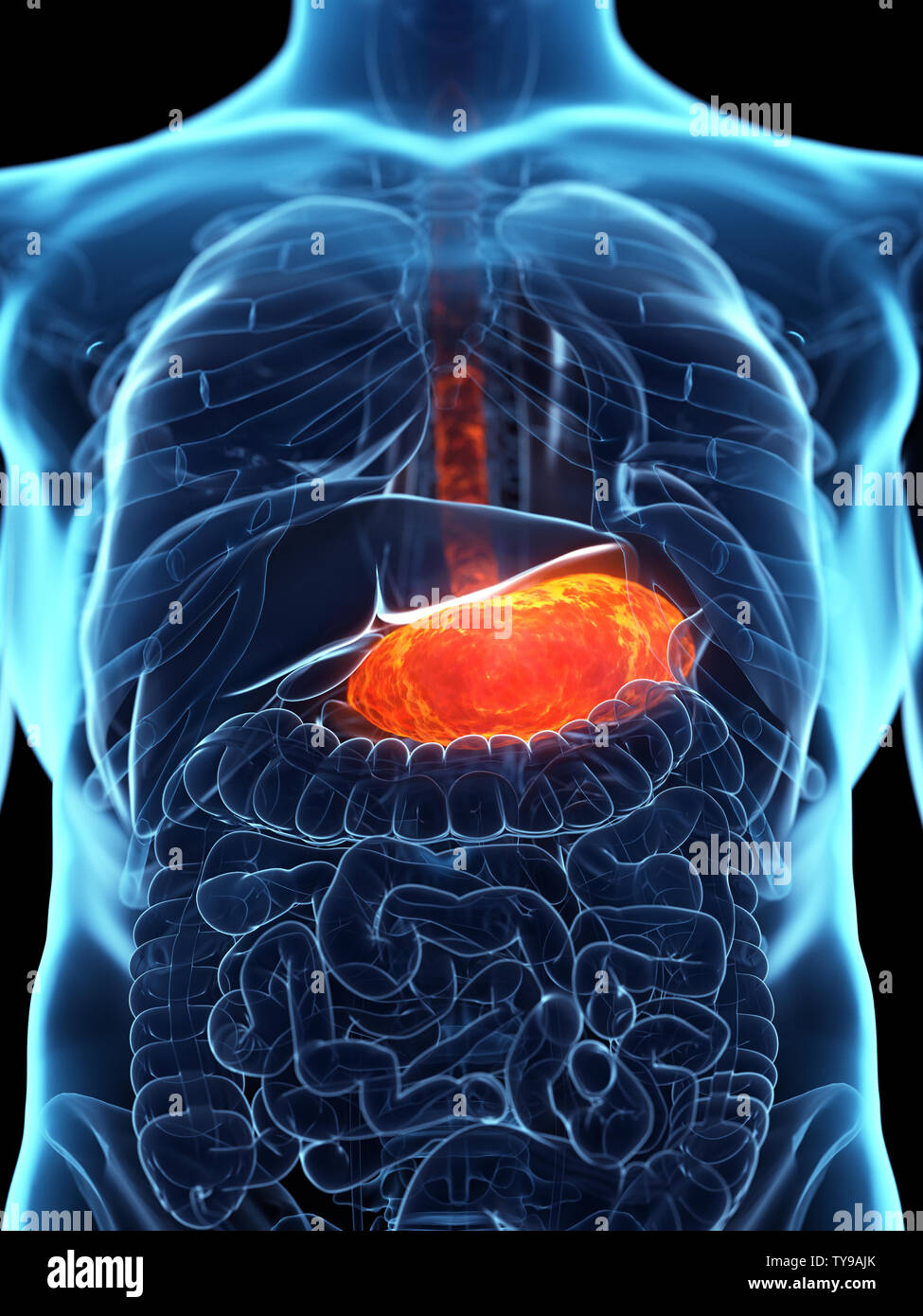 3d rendered medically accurate illustration of a diseased stomach Stock ...