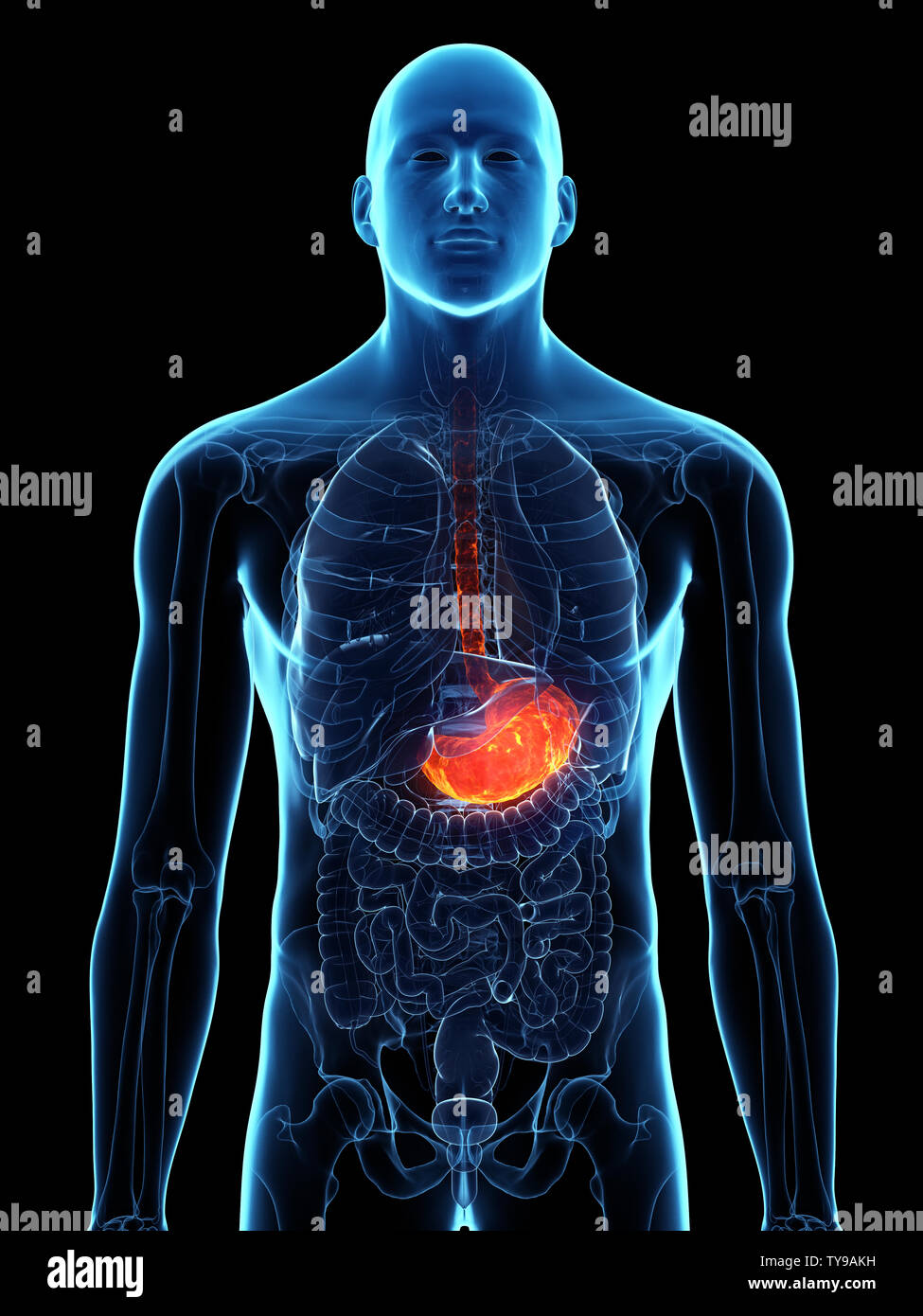 3d rendered medically accurate illustration of a diseased stomach Stock ...