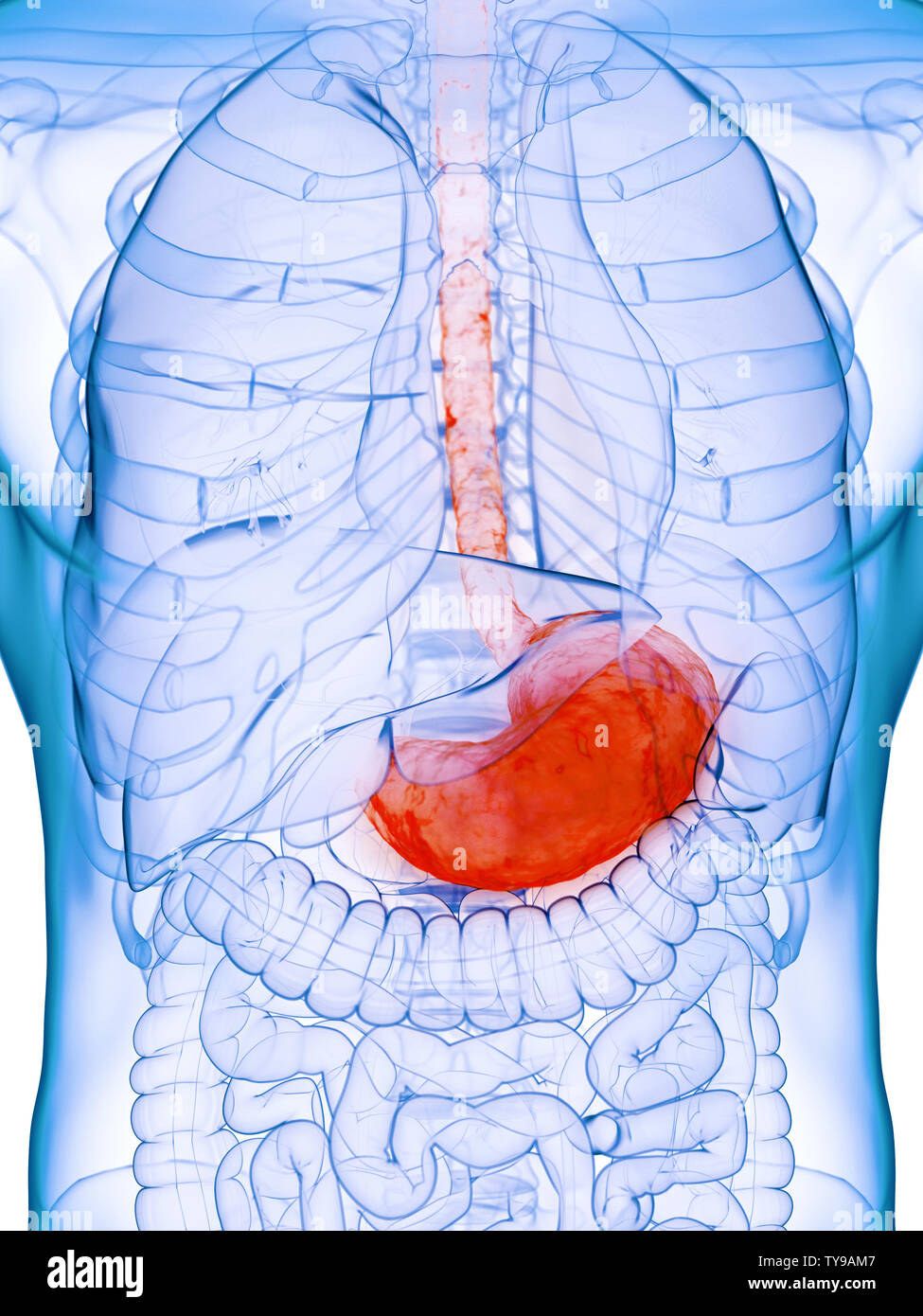 3d rendered medically accurate illustration of a diseased stomach Stock ...