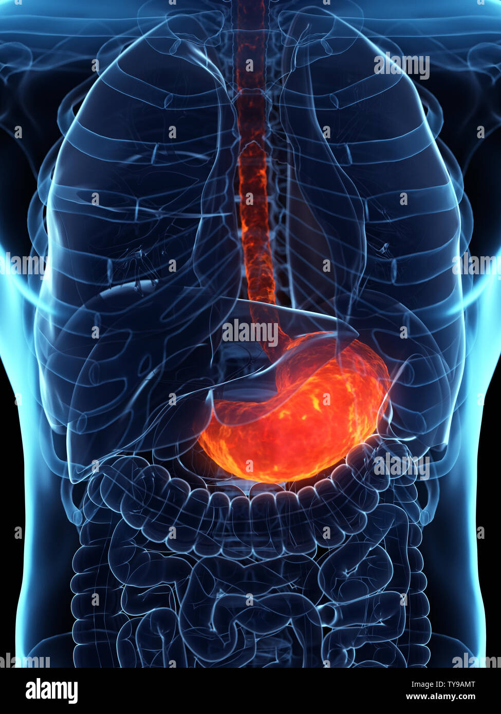 3d rendered medically accurate illustration of a diseased stomach Stock ...