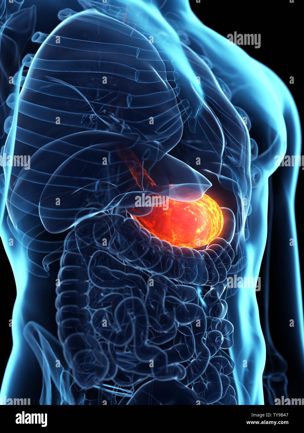 3d rendered medically accurate illustration of a diseased stomach Stock ...
