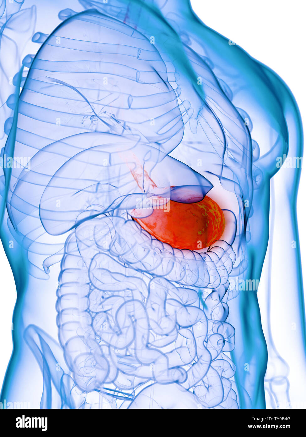 3d rendered medically accurate illustration of a diseased stomach Stock ...