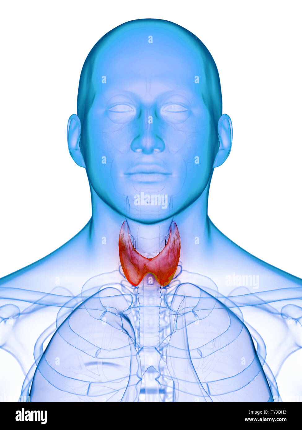 3d rendered medically accurate illustration of a diseased thyroid gland ...