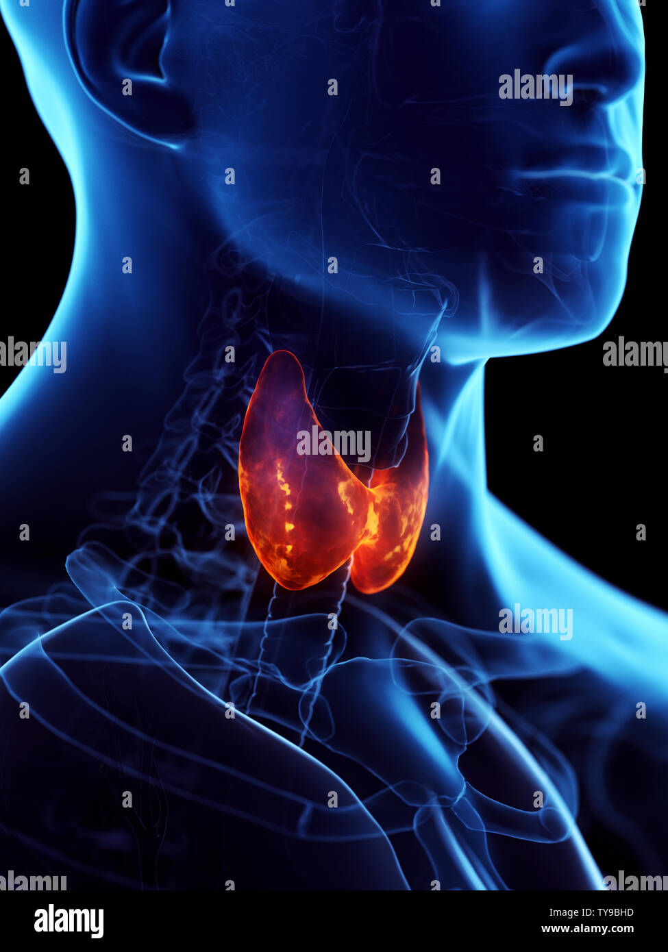 3d rendered medically accurate illustration of a diseased thyroid gland ...