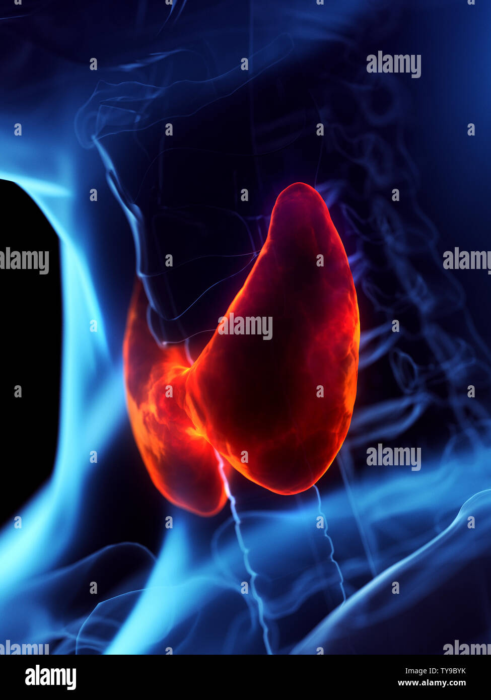 3d rendered medically accurate illustration of a diseased thyroid gland ...