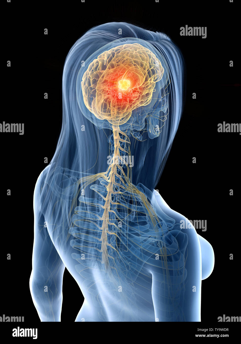 3d rendered medically accurate illustration of brain cancer Stock Photo ...