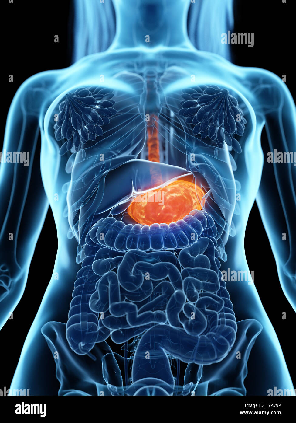 3d rendered medically accurate illustration of a diseased stomach Stock ...
