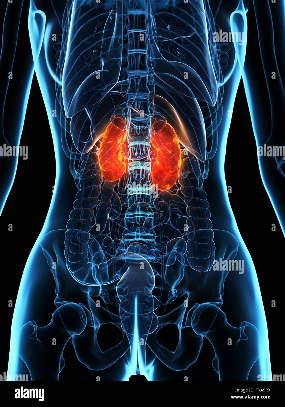 3d rendered medically accurate illustration of diseased kidneys Stock ...
