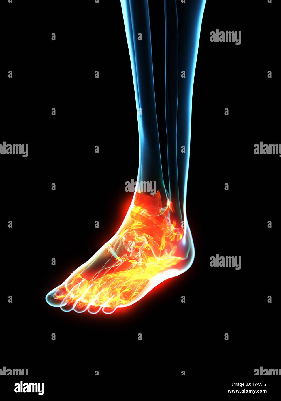 3d rendered medically accurate illustration of inflamed ligaments Stock ...