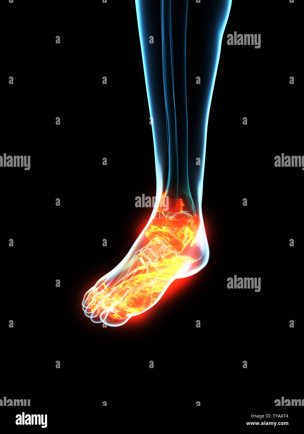 3d rendered medically accurate illustration of inflamed ligaments Stock ...