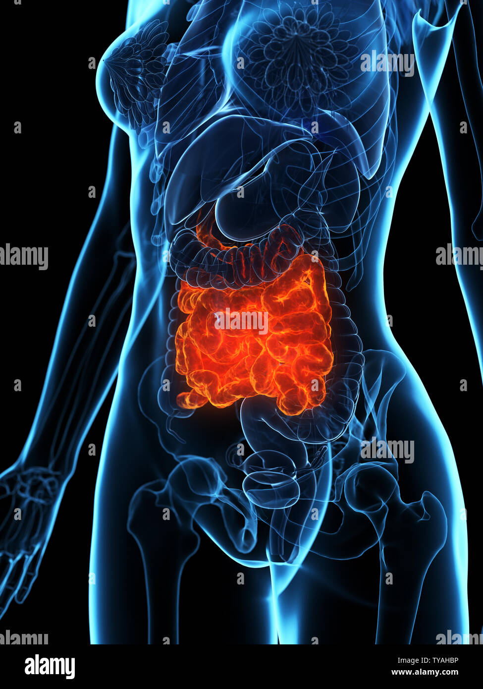 3d rendered medically accurate illustration of a diseases small ...